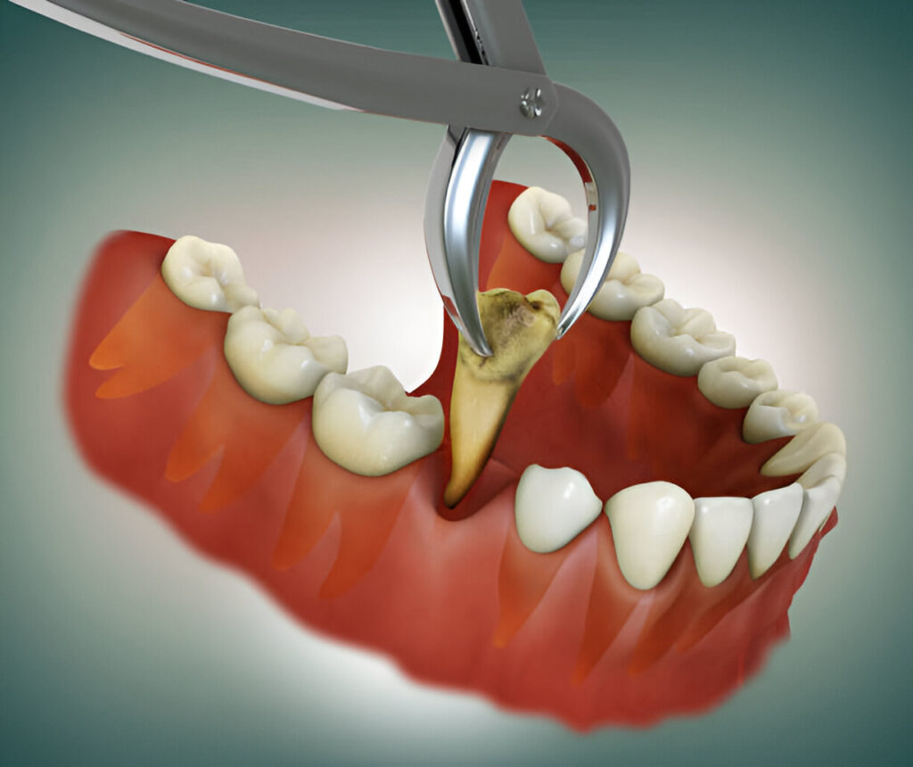 Tooth Extractions – Dental